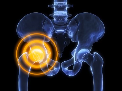 Hip Injury Pain After an Accident: What it Could Mean - Hancock Injury ...